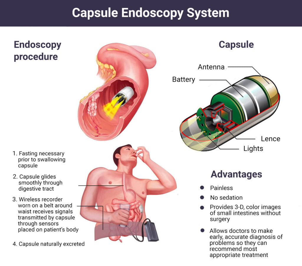Small Bowel Capsule Endoscopy Nyc Best Gi Doctors New York