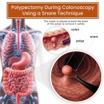 Understanding Polyps and Their Treatment - Manhattan Gastroenterology